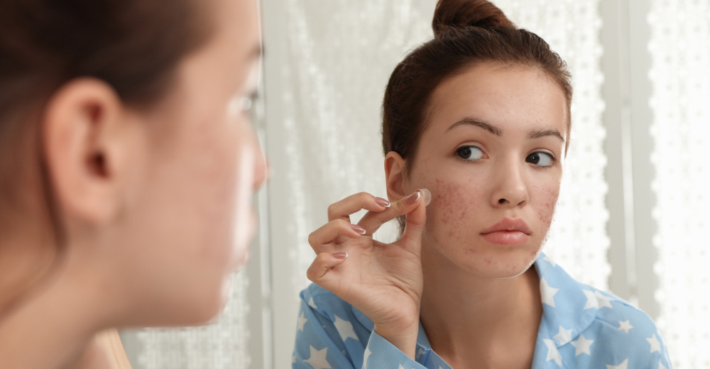 The 10 Best Pimple Patches to Clear Your Acne Overnight (2020) - 22 Words