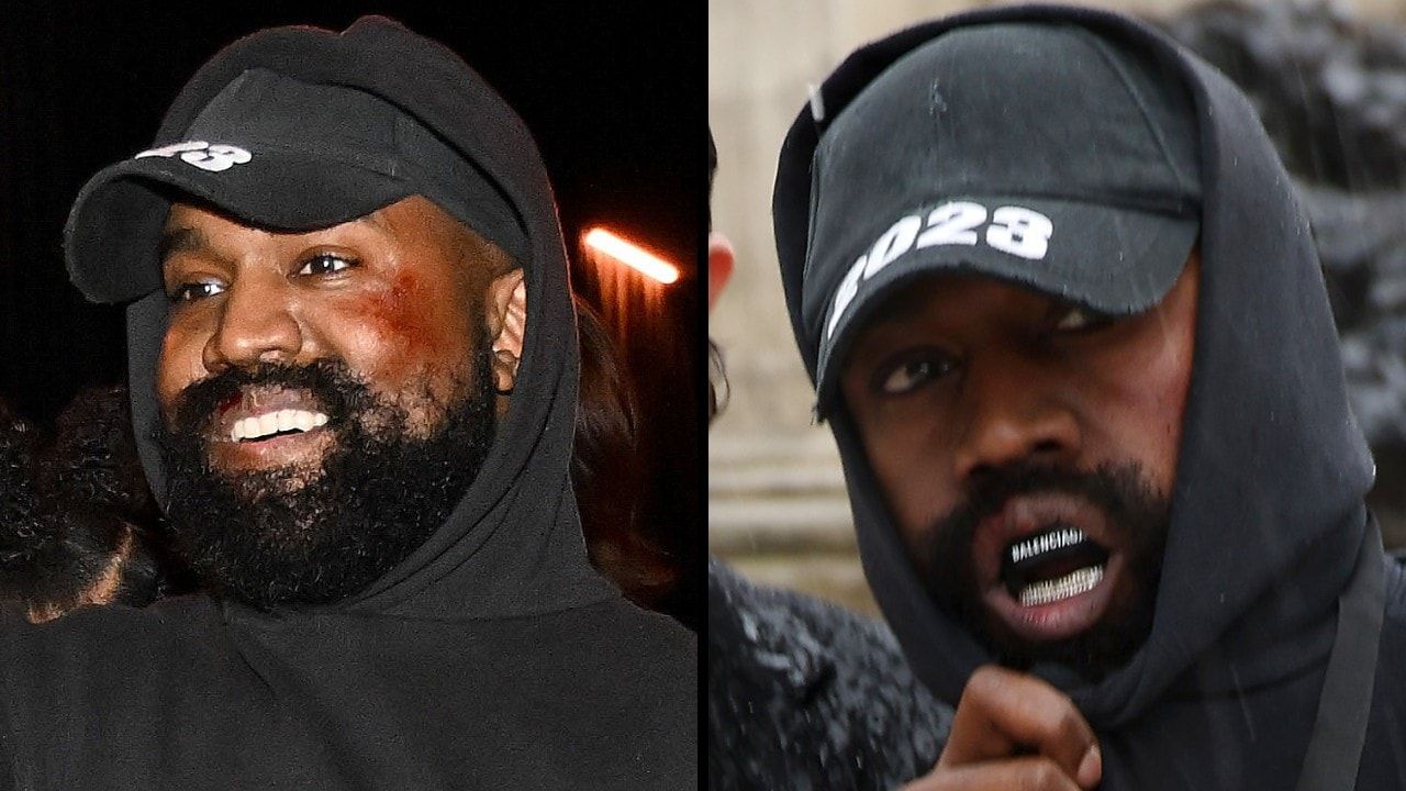 Kanye West Sports Mystery Red Marks on his Face and Lips